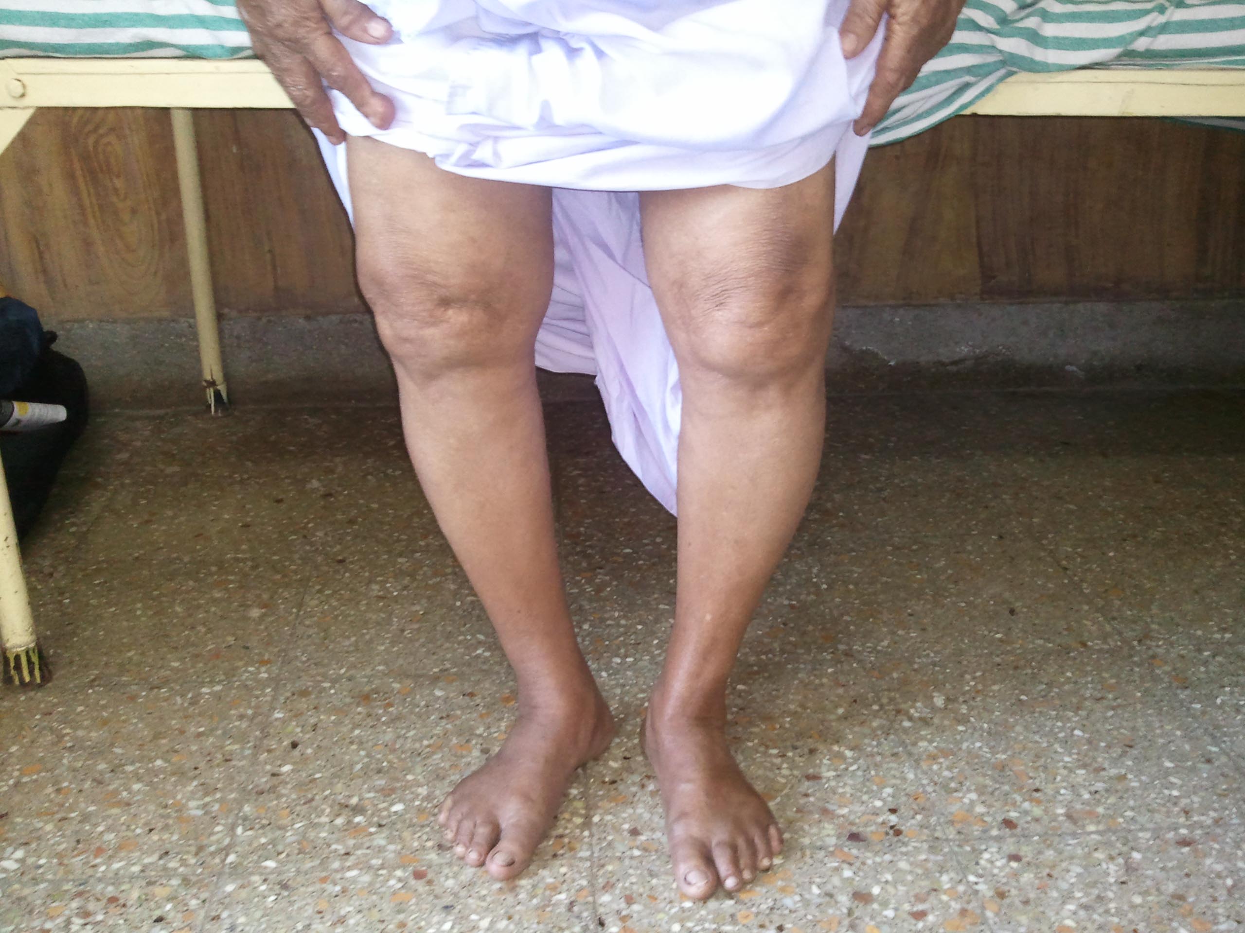 Patients Photo – Dr. PRAMOD MOHAN