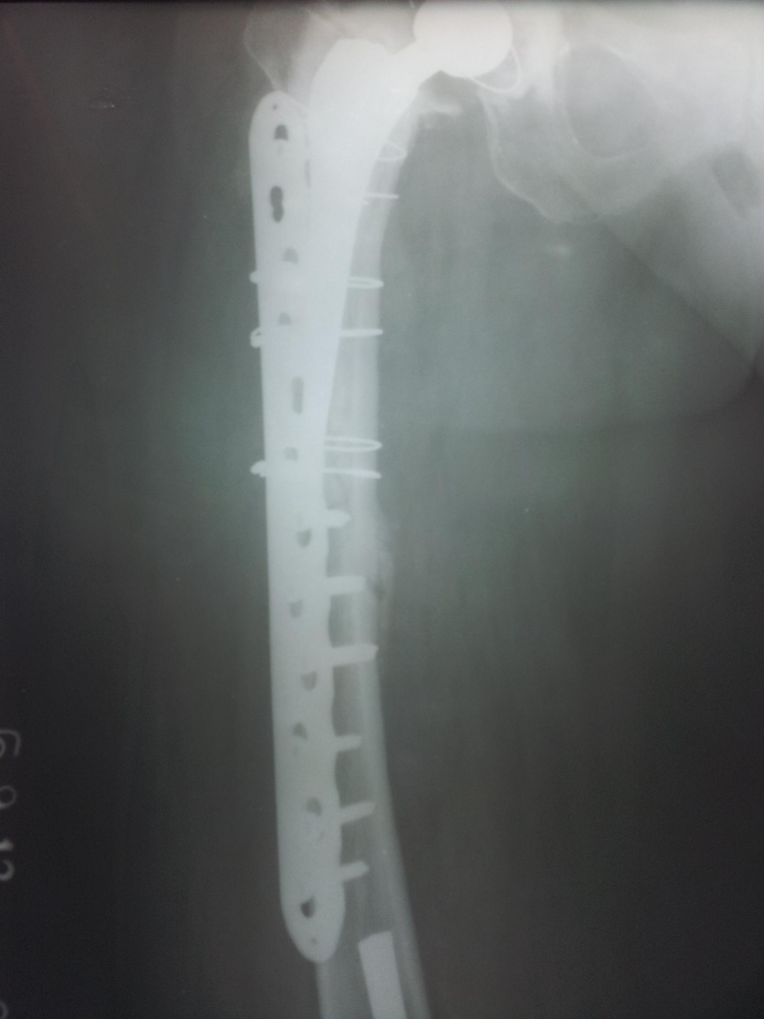 Hip Surgery – Dr. PRAMOD MOHAN